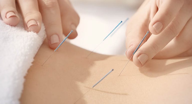 Acupuncture – Specialized Pain Management